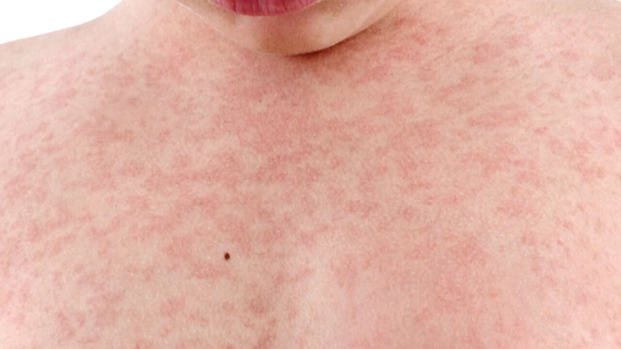 Measles case investigated in Pinellas County, Florida