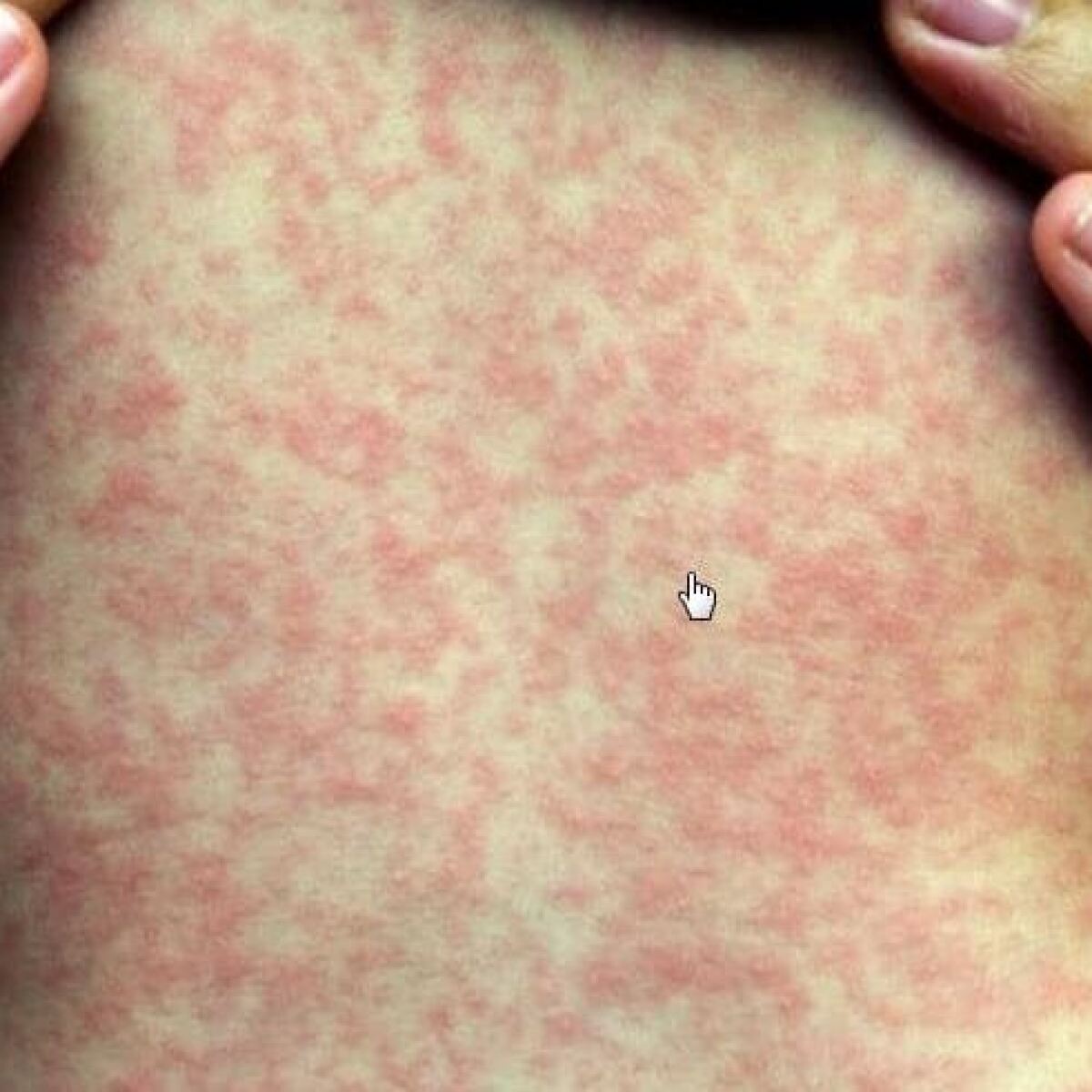 Measles warning issued after man diagnosed in Las Vegas