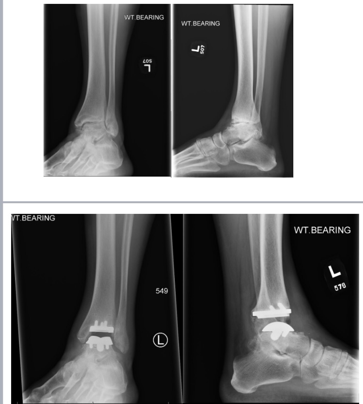 Total Ankle Replacement Surgery Aims To Help Those Impacted By Years Of