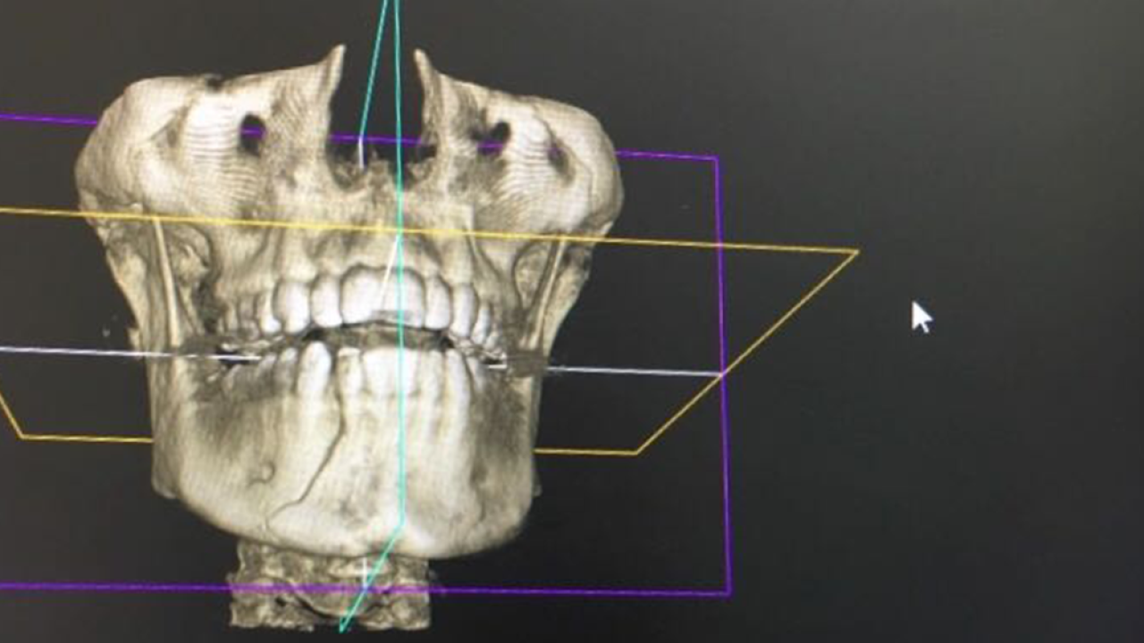 USF student suffering broken jaw after attack at dorm, father says