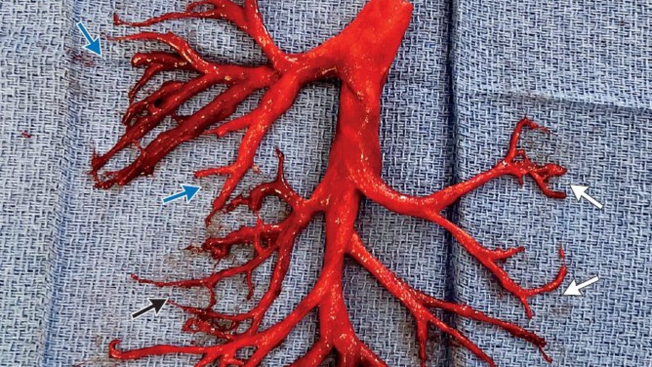 Man coughs up astonishing blood clot shaped like a bronchial tree
