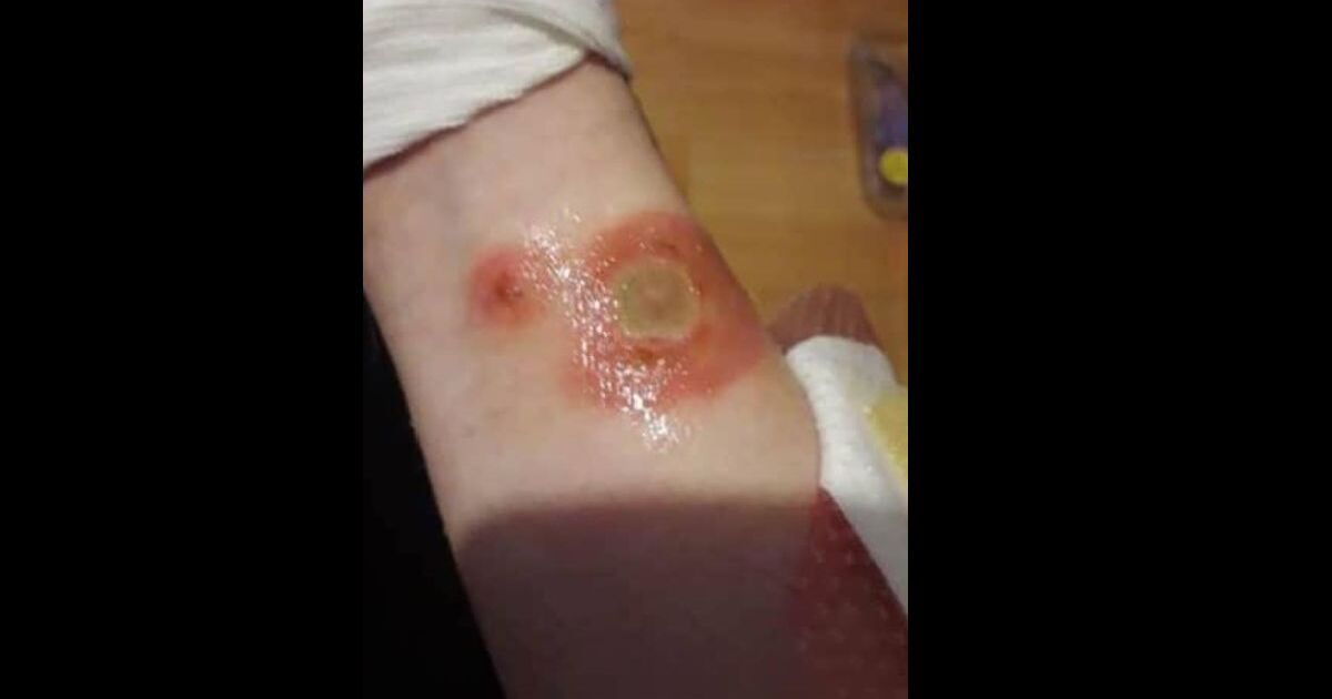 Woman Warns Parents After Daughter Burned Doing deodorant Challenge woman-warns-parents-after-daughter-burned-doing-deodorant-challenge
