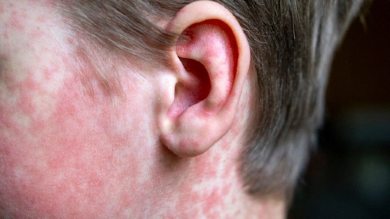 First measles case confirmed in Bell County First measles case confirmed in Bell County