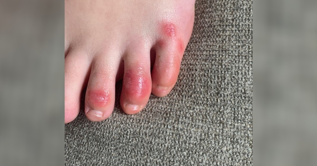 'COVID toes' may be coronavirus symptom, especially in youth